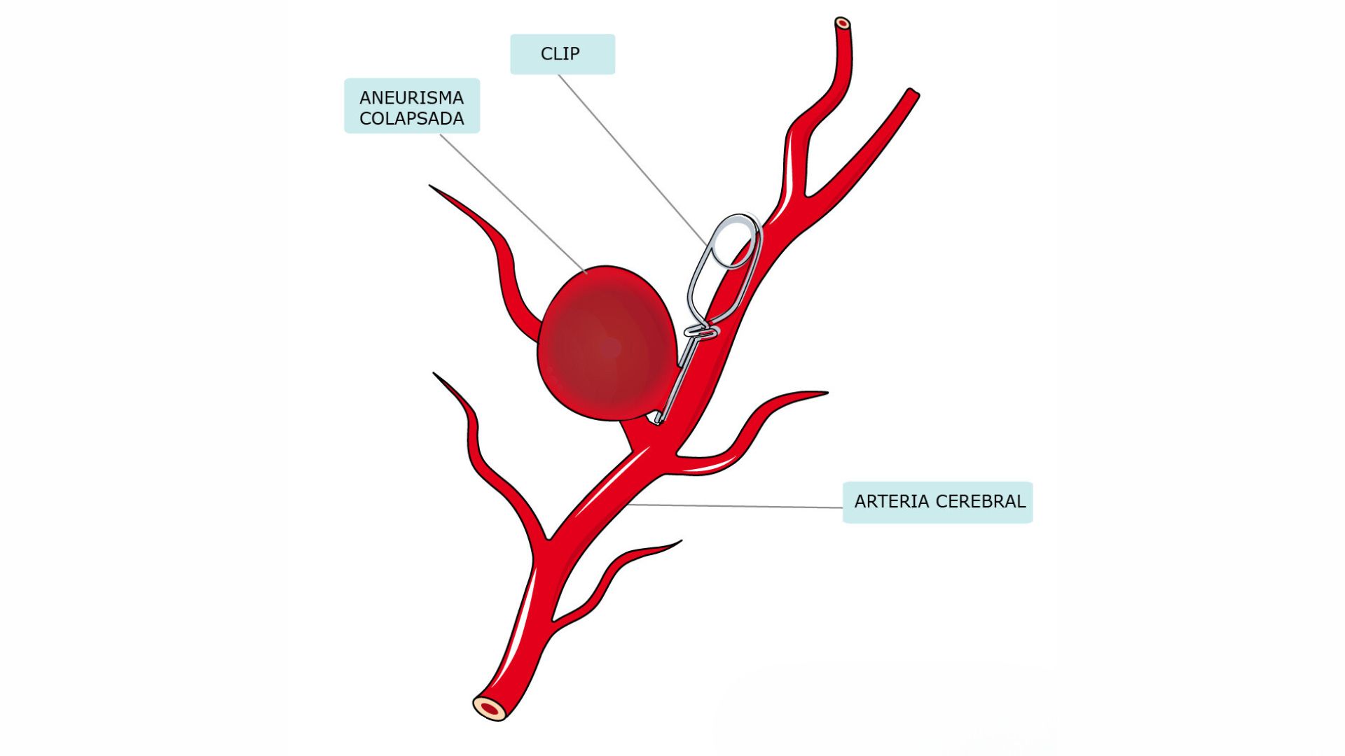 Clipaje de aneurisma cerebral: qué saber | Hospital de Bellvitge