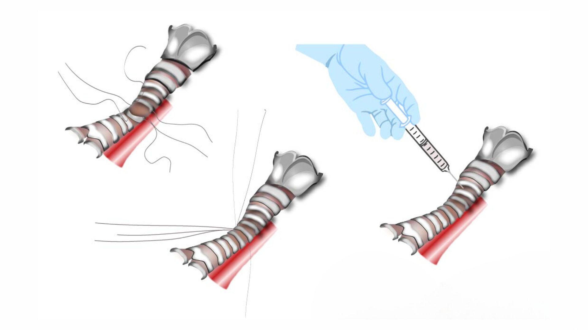 Resección traqueal: qué hay que saber | Hospital de Bellvitge
