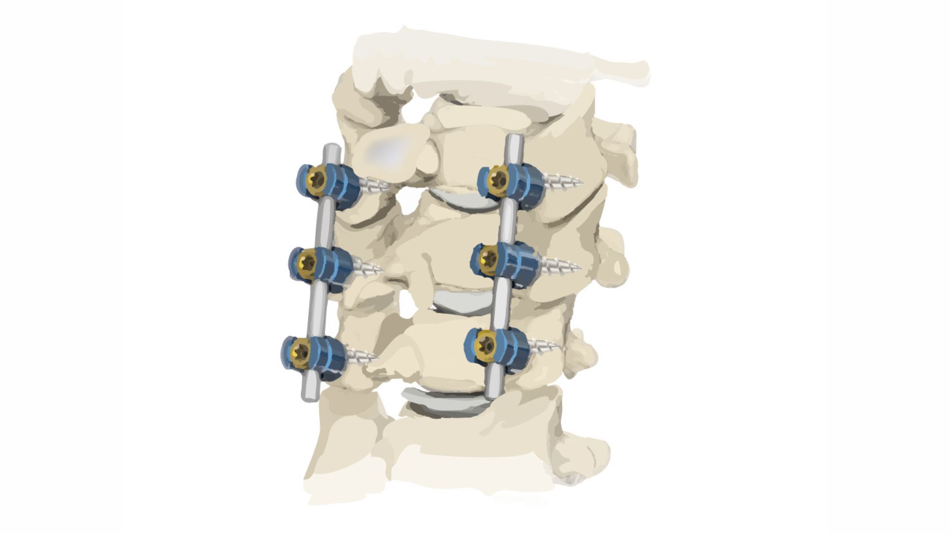 Cirugía de columna cervical: qué saber | Hospital de Bellvitge