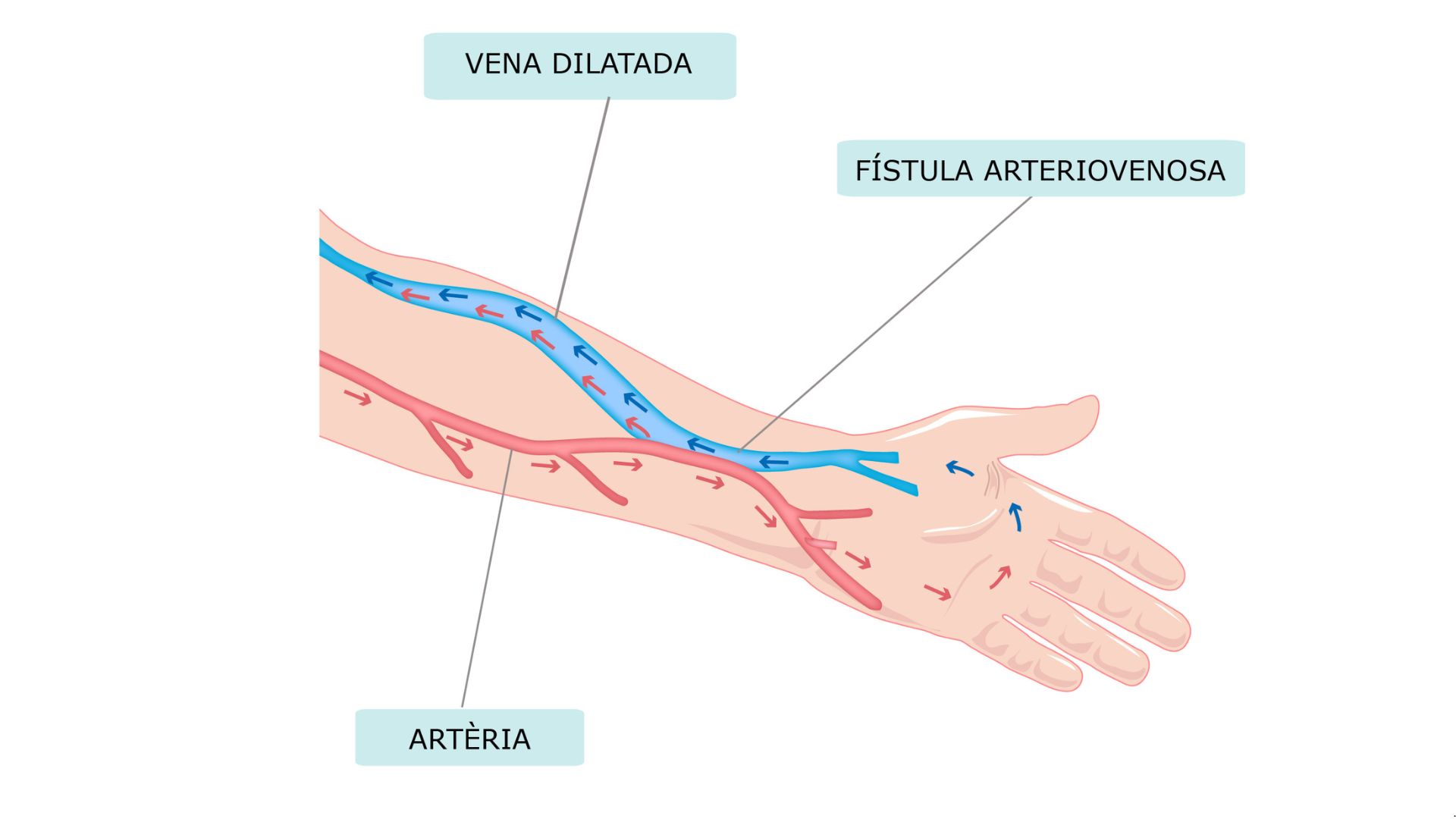 Fístula arteriovenosa: què cal saber | Hospital de Bellvitge