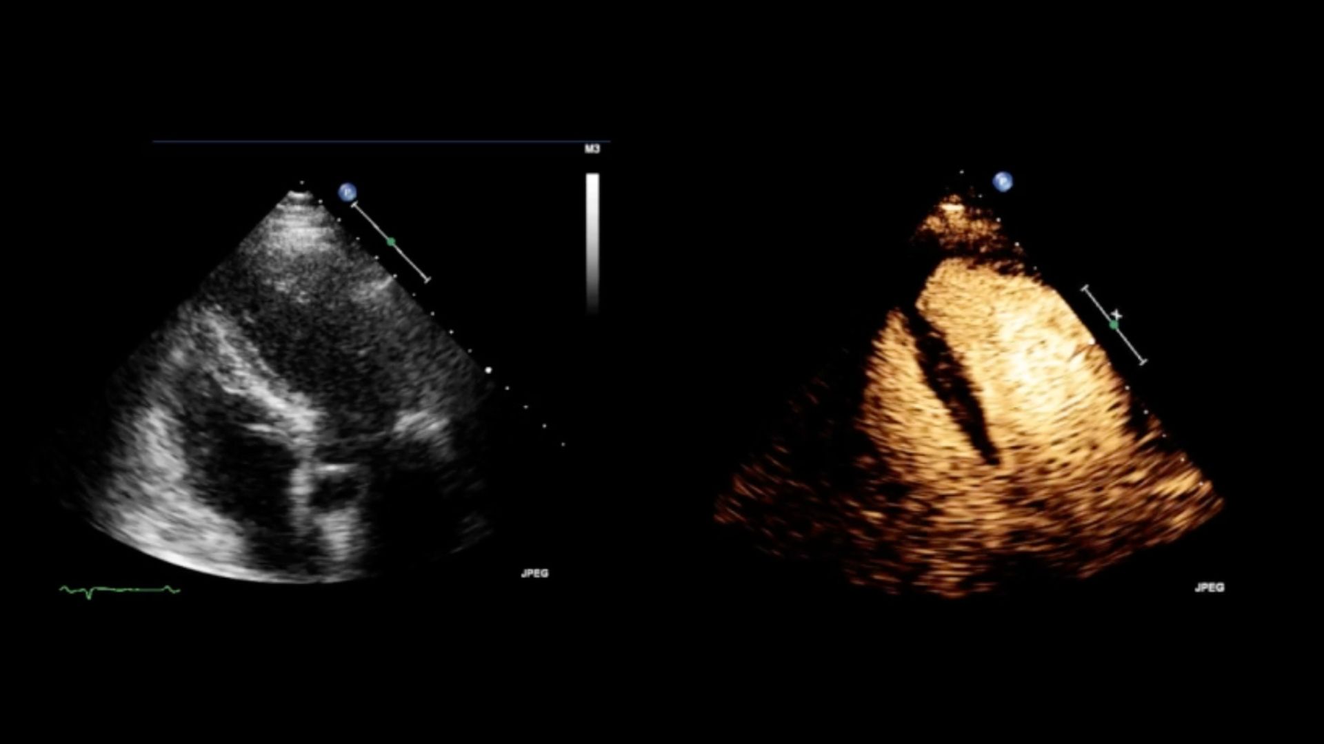 Ecocardiografia amb contrast "SonoVue": què cal saber | Hospital de ...