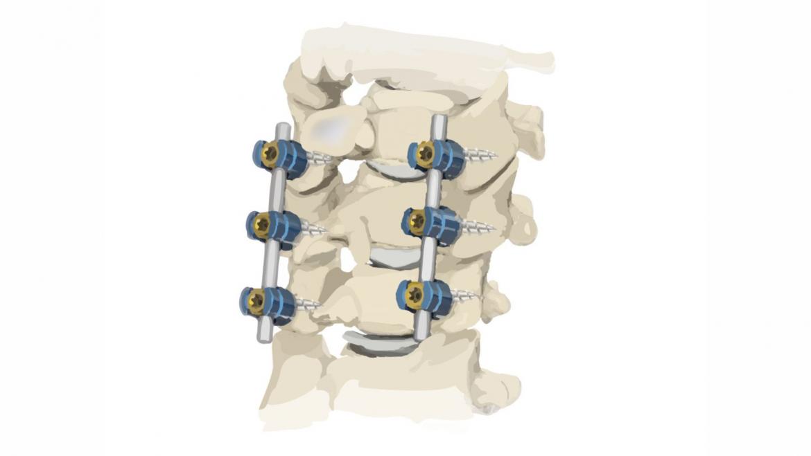 Cirugía de columna cervical: qué saber | Hospital de Bellvitge