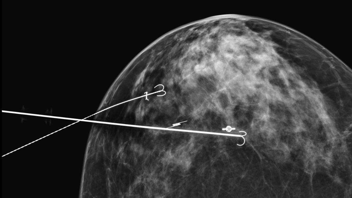 Biopsia asistida por vacío (BAV): qué saber | Hospital de Bellvitge