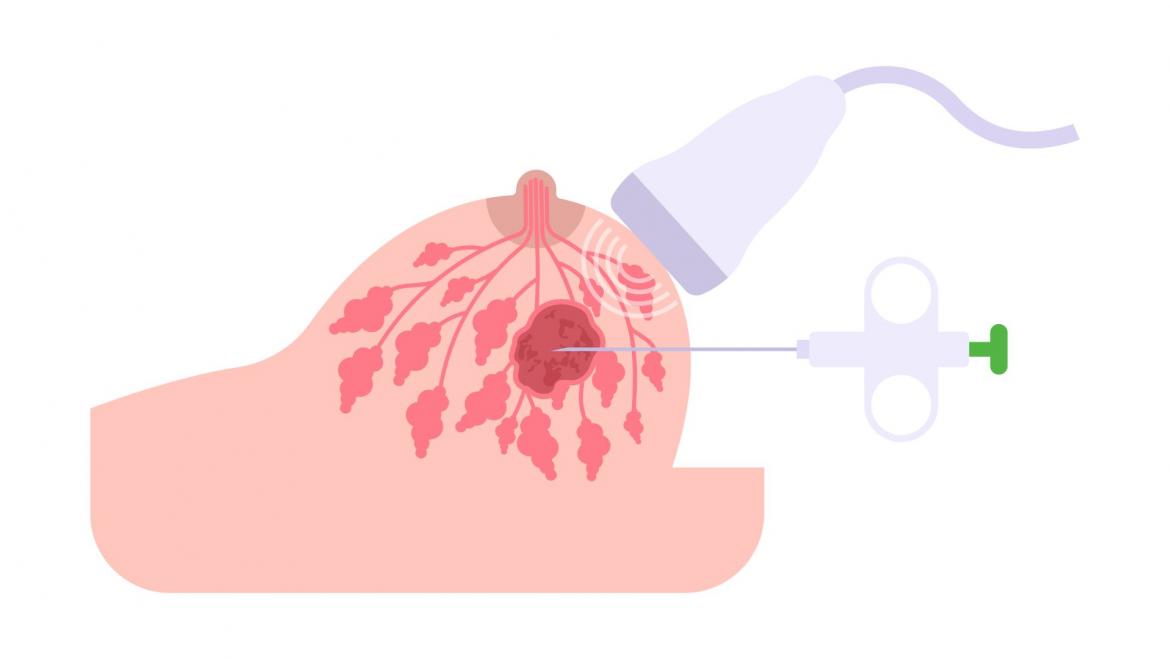 Biopsia de mama con aguja gruesa (BAG) | Hospital de Bellvitge